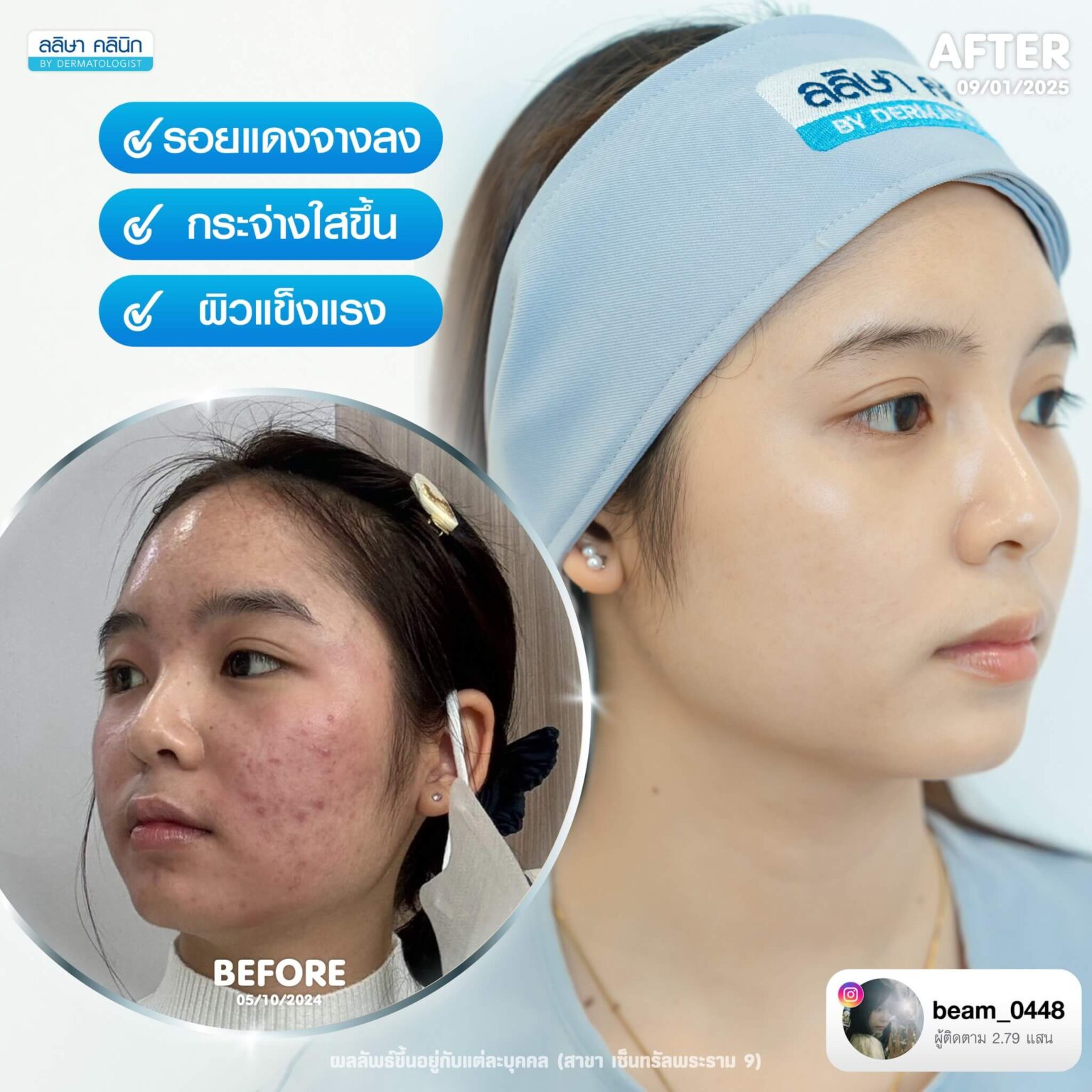 เลเซอร์ วีบีม (Vbeam laser) คืออะไร? ช่วยลดรอยจากสิวได้จริงไหม ...