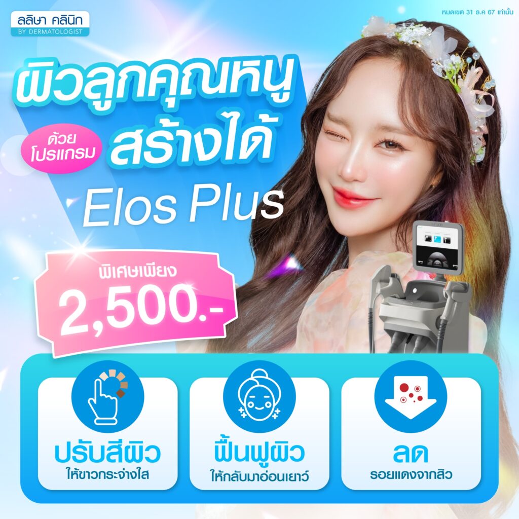 elos plus laser ทางเลือกในการรักษารอยสิวอย่างมีประสิทธิภาพ - LALIZA Clinic