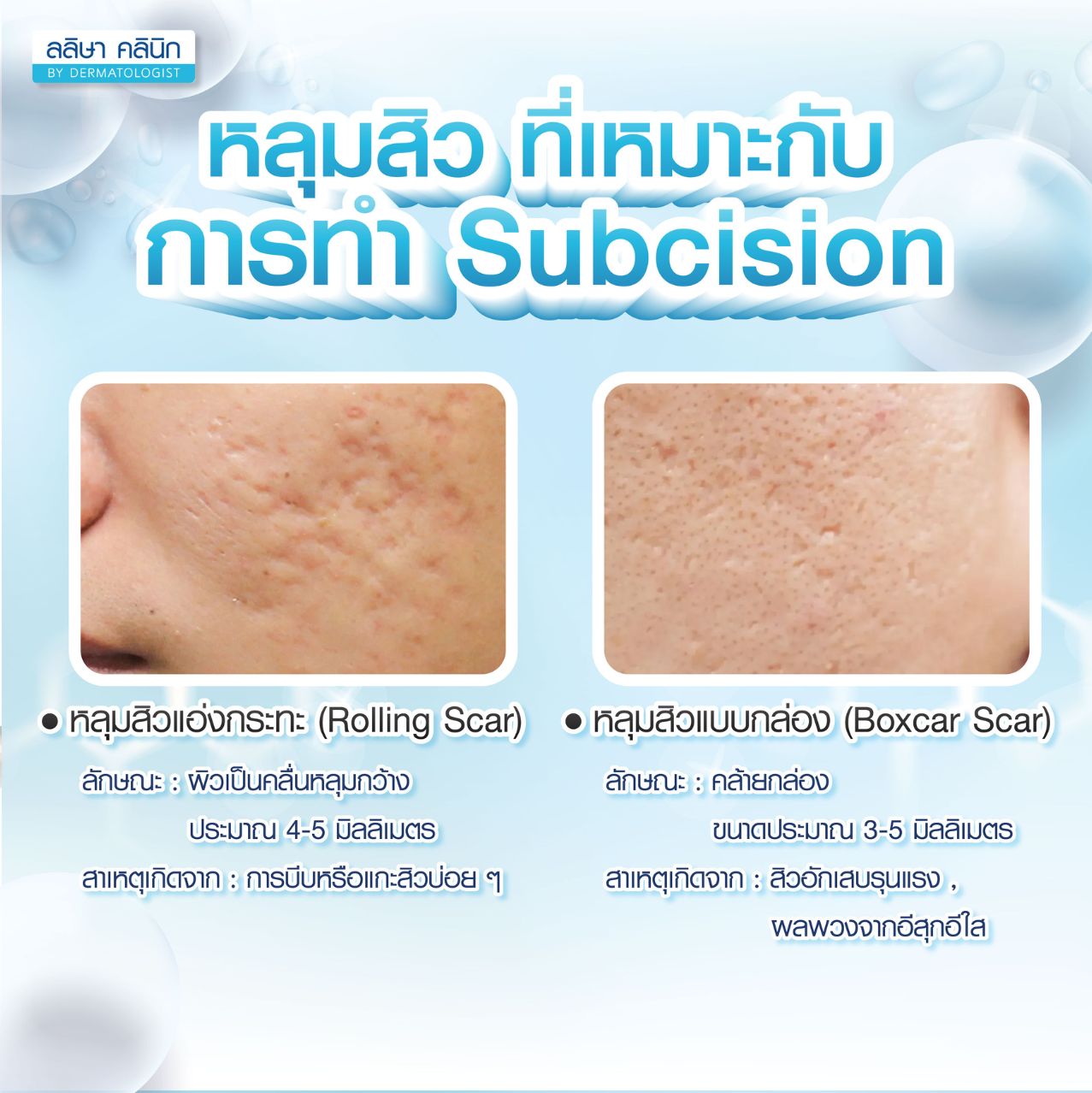 Subcision หลุมสิว คืออะไร? รักษาหลุมสิวได้จริงไหม - คลินิกผิวหนังลลิษา โดยแพทย์เฉพาะทาง